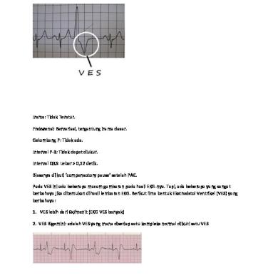 Adapun Gambaran EKG Pada VES Adalah Sebagai Berikut [PDF] | Documents ...